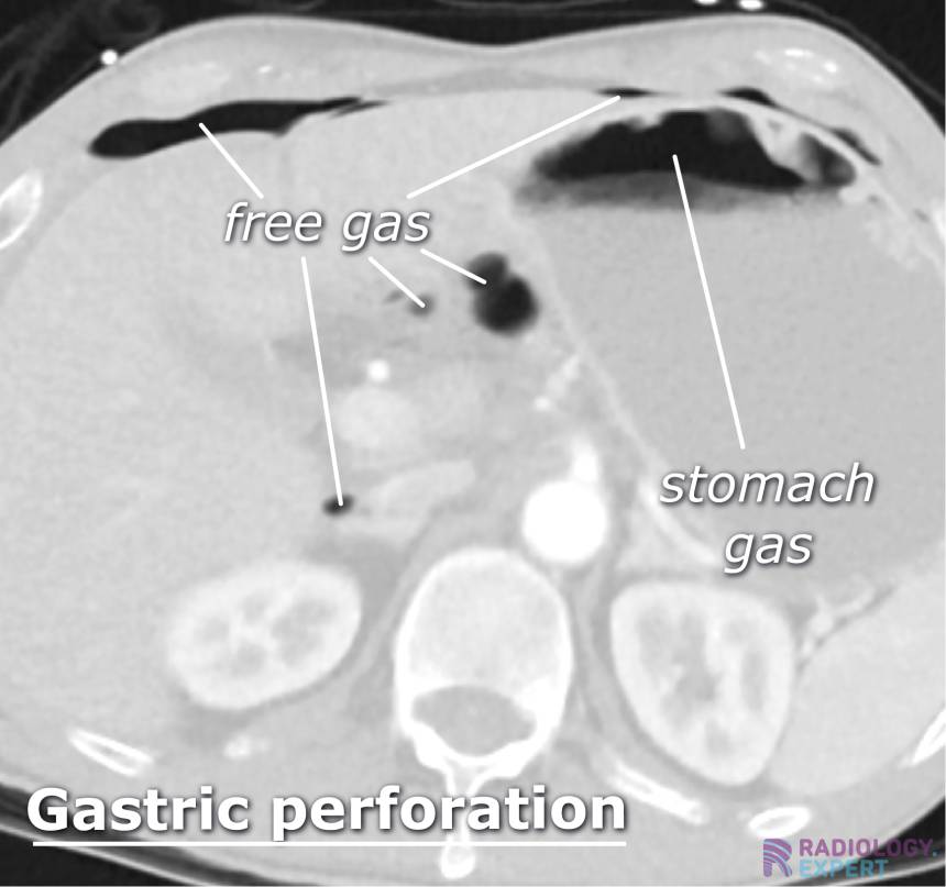 CT abdomen general